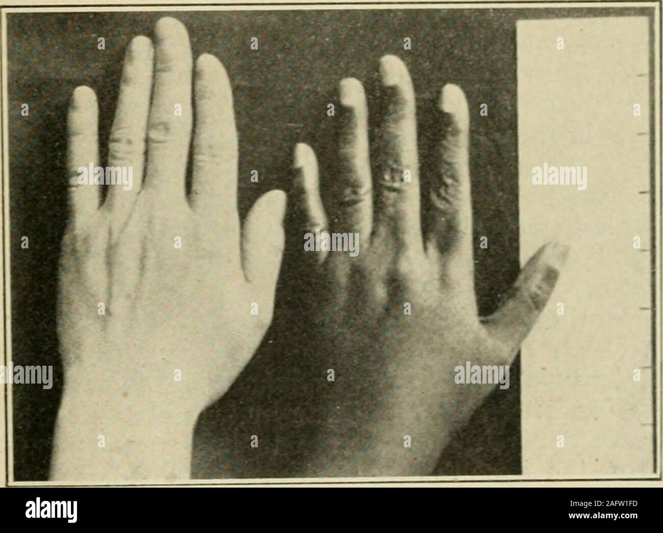 Nervous prostration hi-res stock photography and images - Alamy