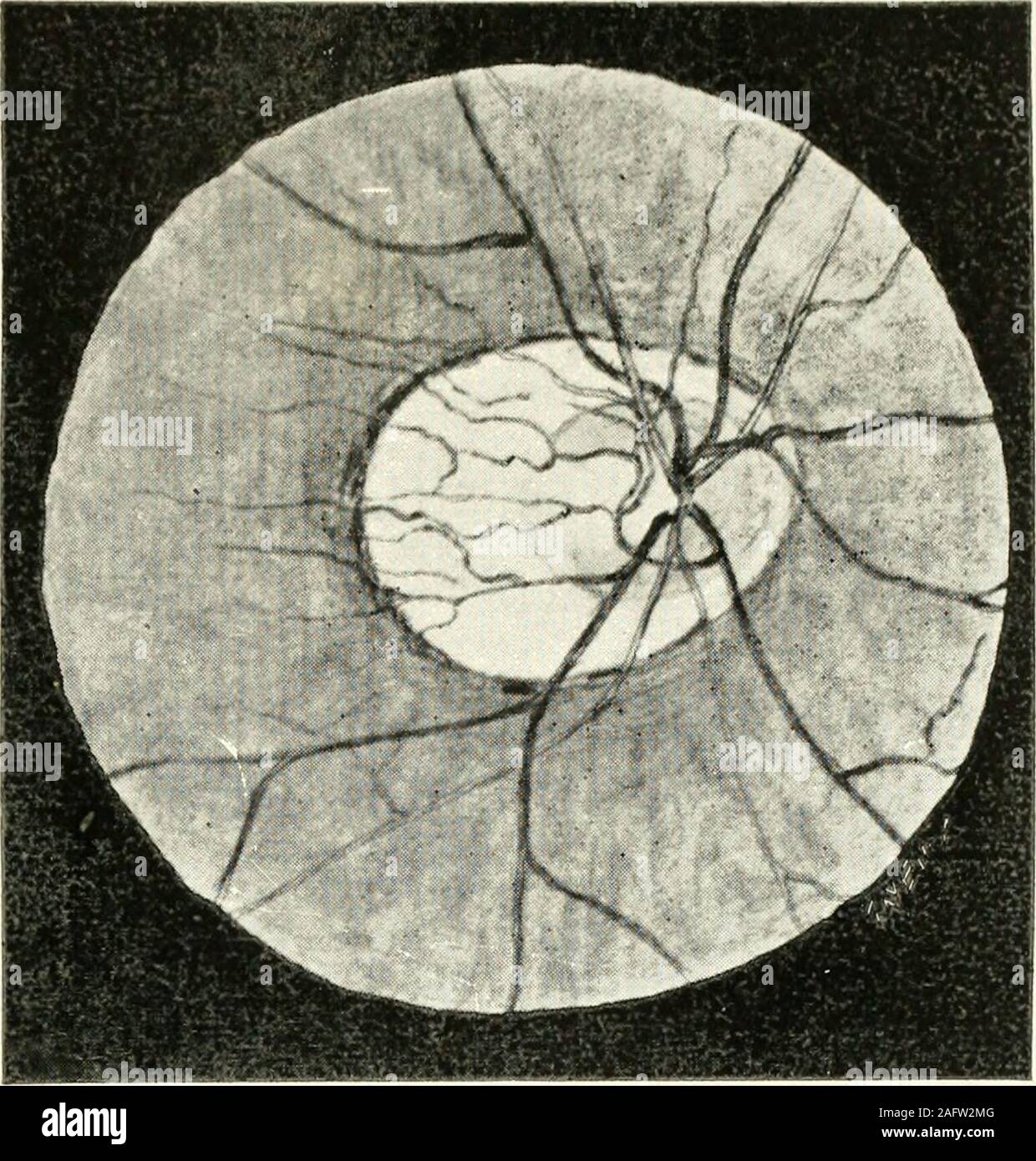 Hemorragia en hi-res stock photography and images - Alamy