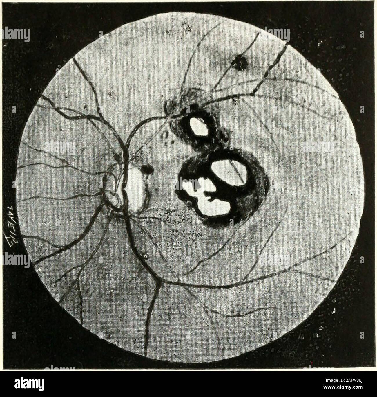 . Oftalmología; estadística [1.]-3. ser. Fig. B.— Embolia arteria ...