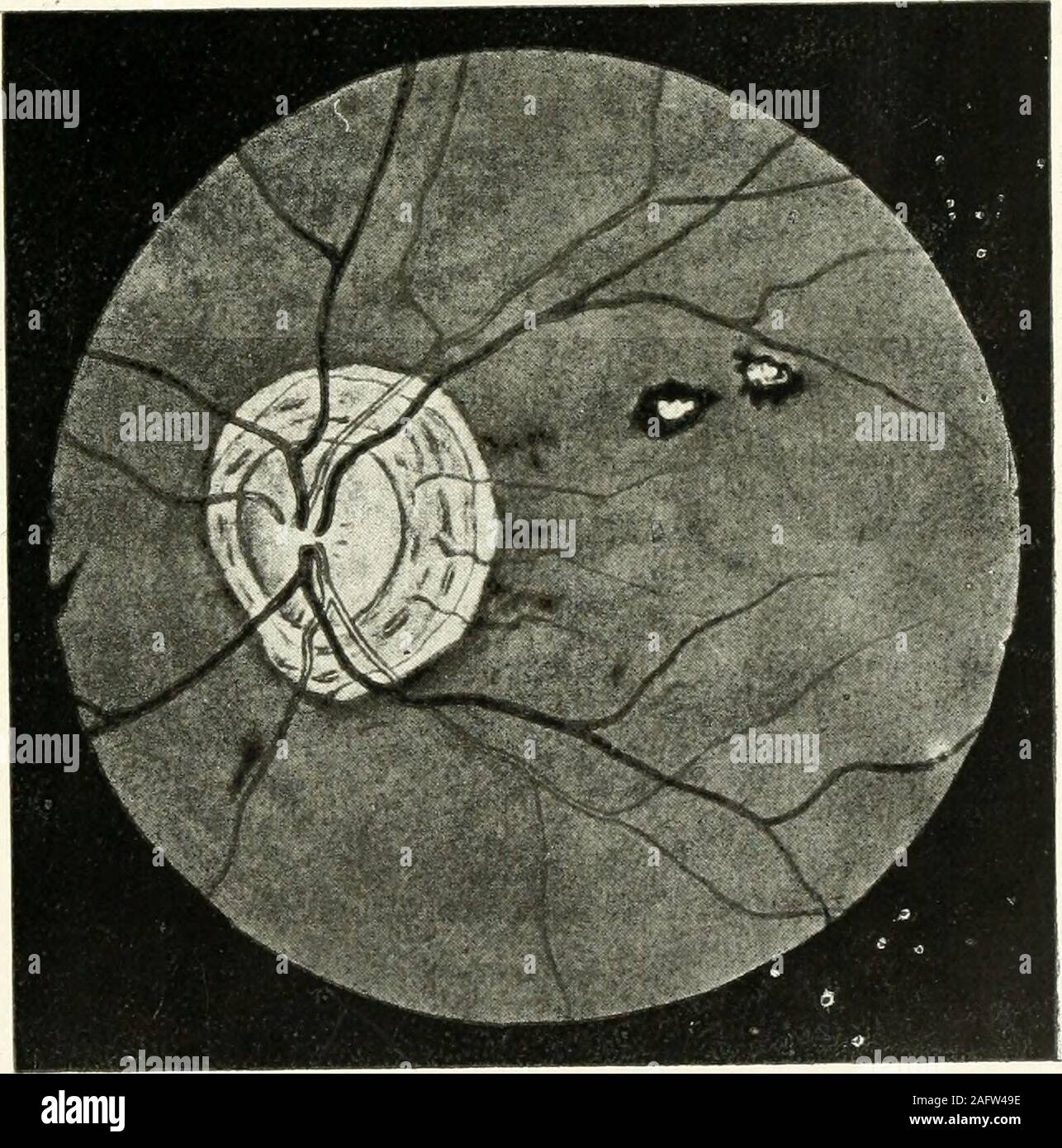 . Oftalmología; estadística [1.]-3. ser. Fig. A.—O. D. Retinitis ...