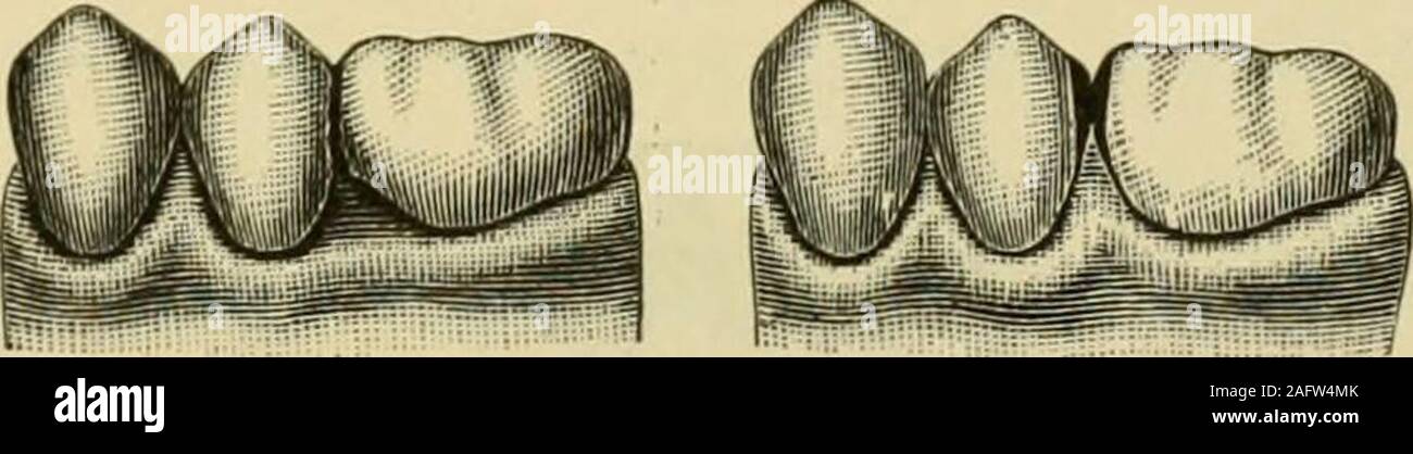 Caries proximal hi-res stock photography and images - Alamy