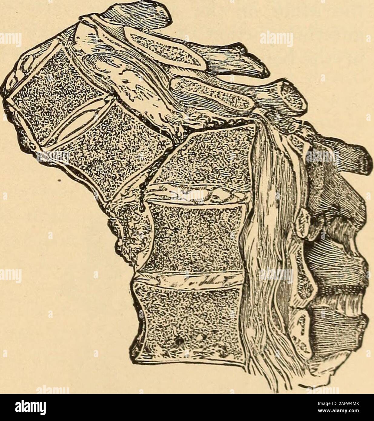 Transverse bone fracture hi-res stock photography and images - Alamy