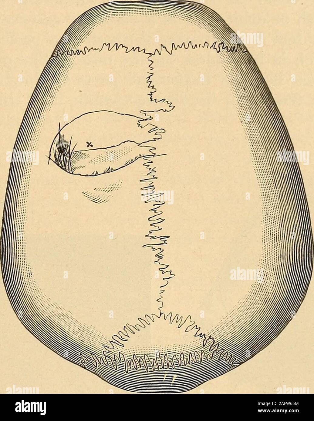Depressed skull fracture hi-res stock photography and images - Alamy
