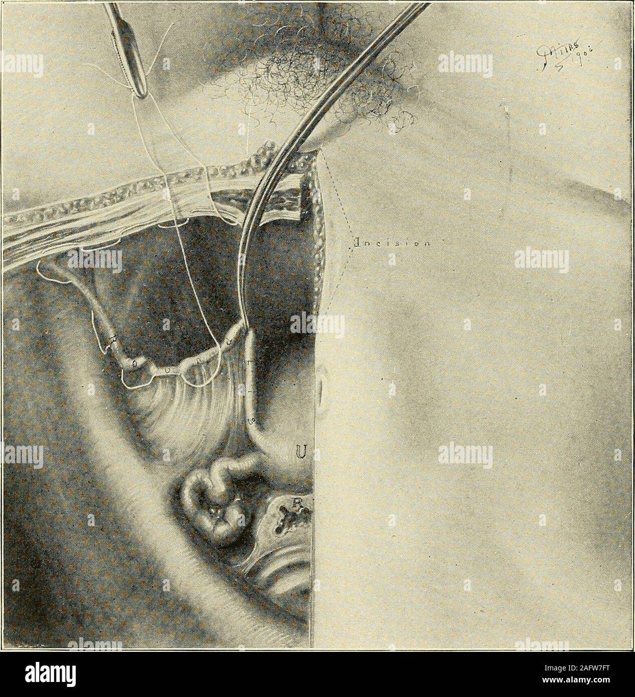 Round ligament of uterus hi-res stock photography and images - Alamy