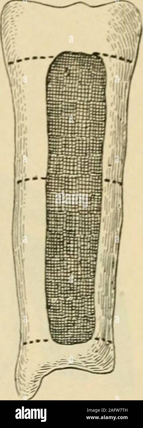 . Manual of operative surgery. Fig. iiiji. Fig. 1153. Figs. 1151, 1152 ...