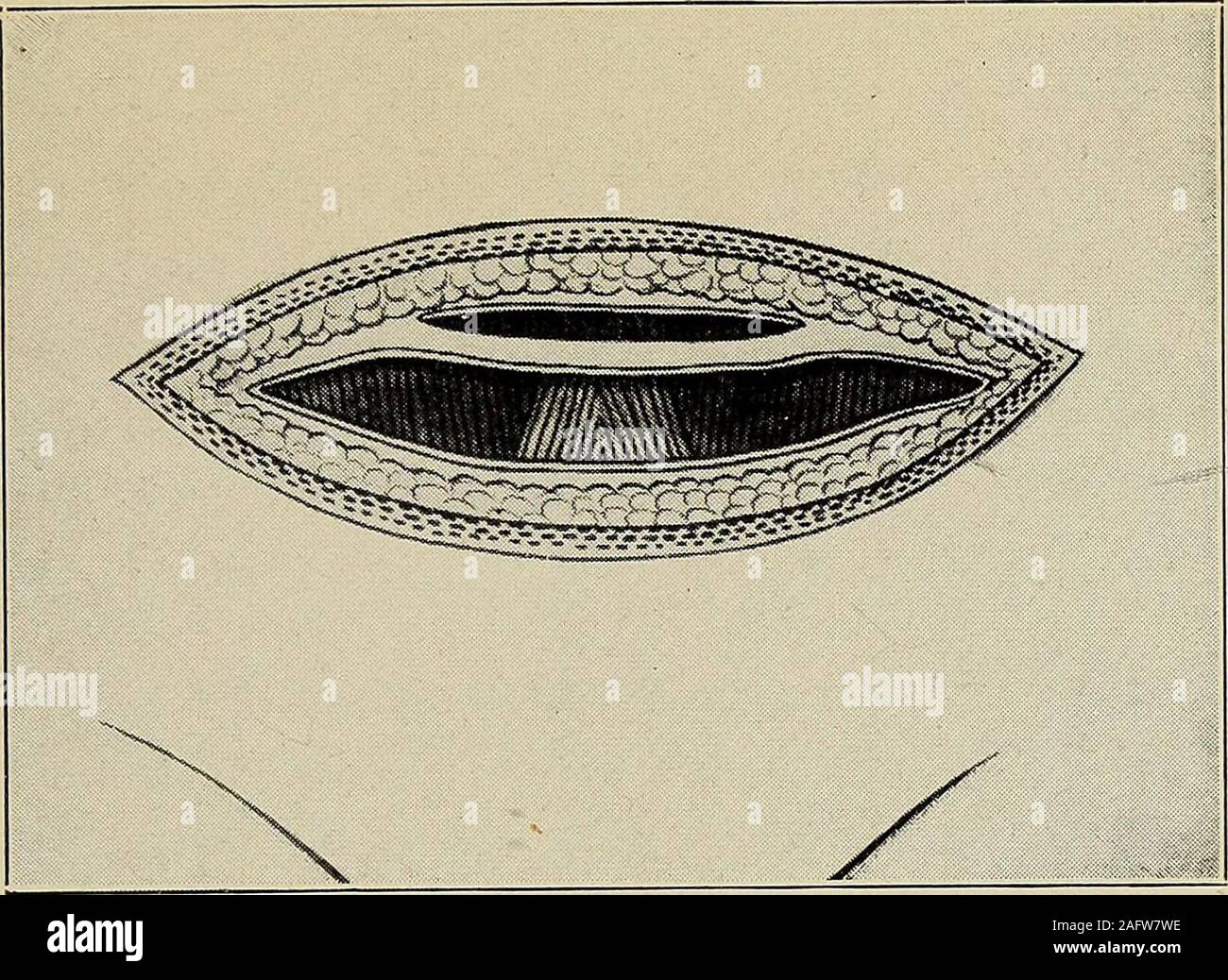 Pfannenstiel incision hi-res stock photography and images - Alamy