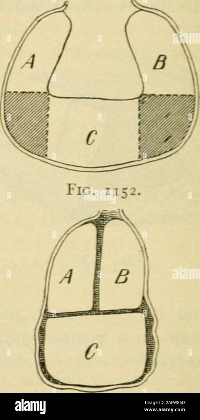 . Manual of operative surgery. Fig. iiiji. Fig. 1153. Figs. 1151, 1152 ...