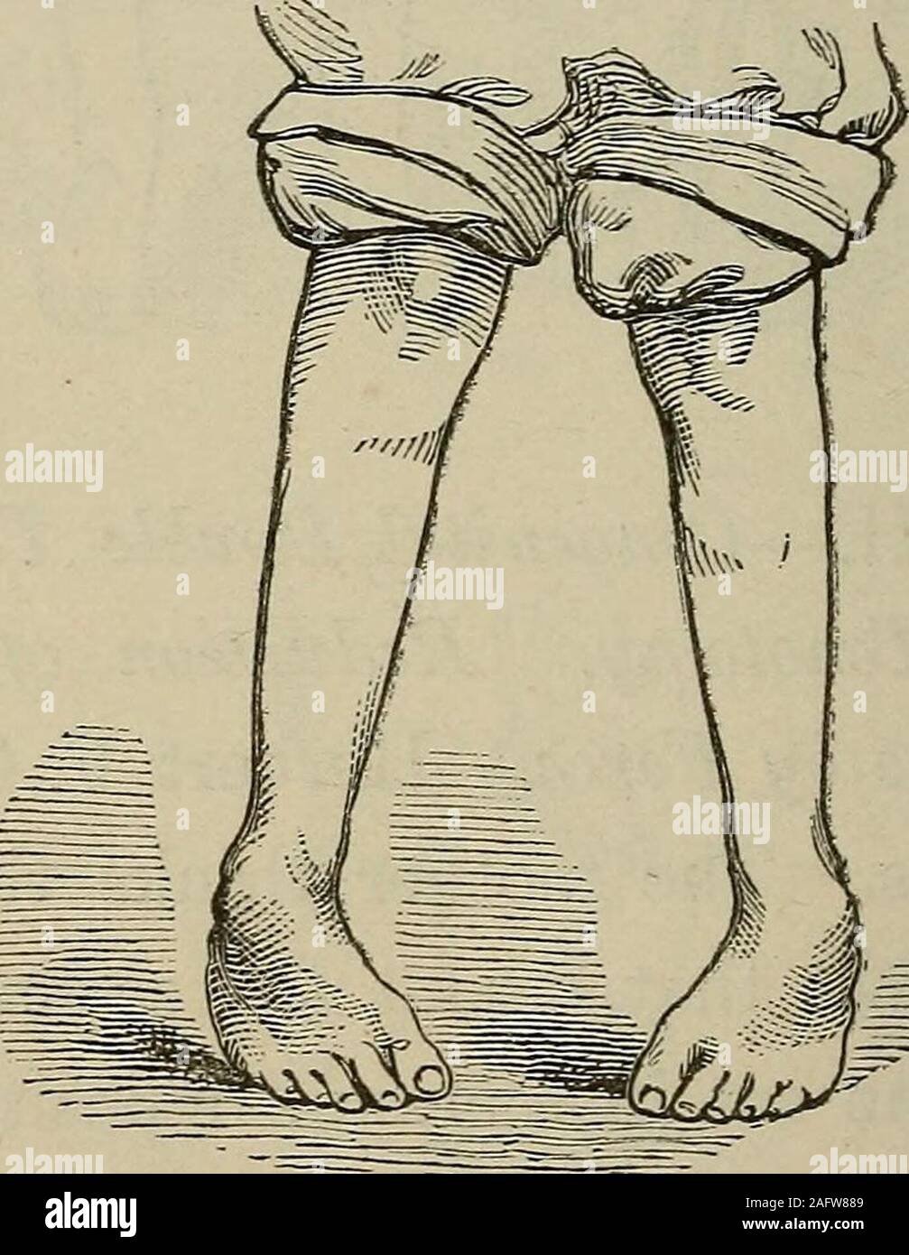 . A practical manual of the treatment of club-foot. of DislocatedTarsal ...