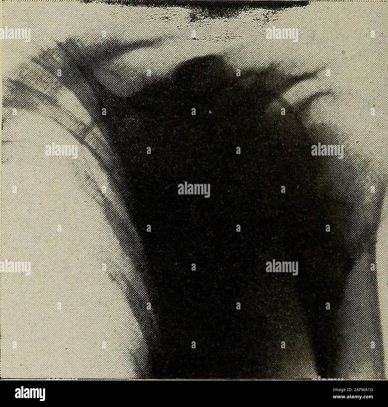 . Transactions of the Western Surgical Association. Fig. 11. Compound ...