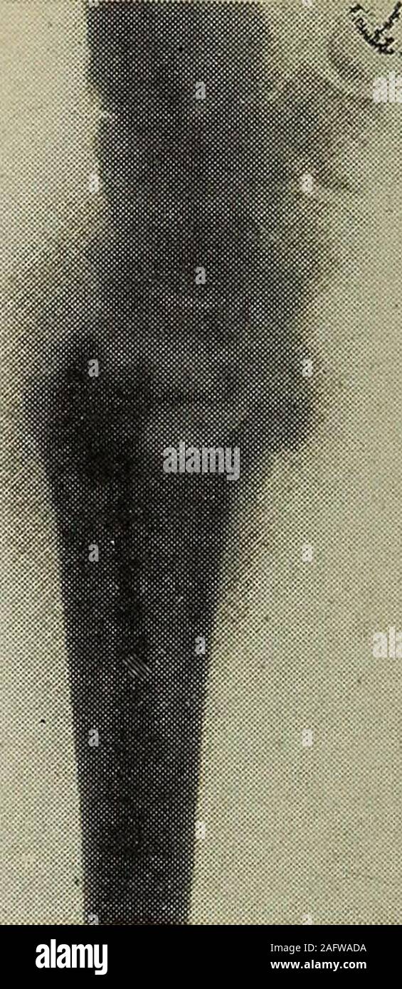 Comminuted fracture hi-res stock photography and images - Alamy