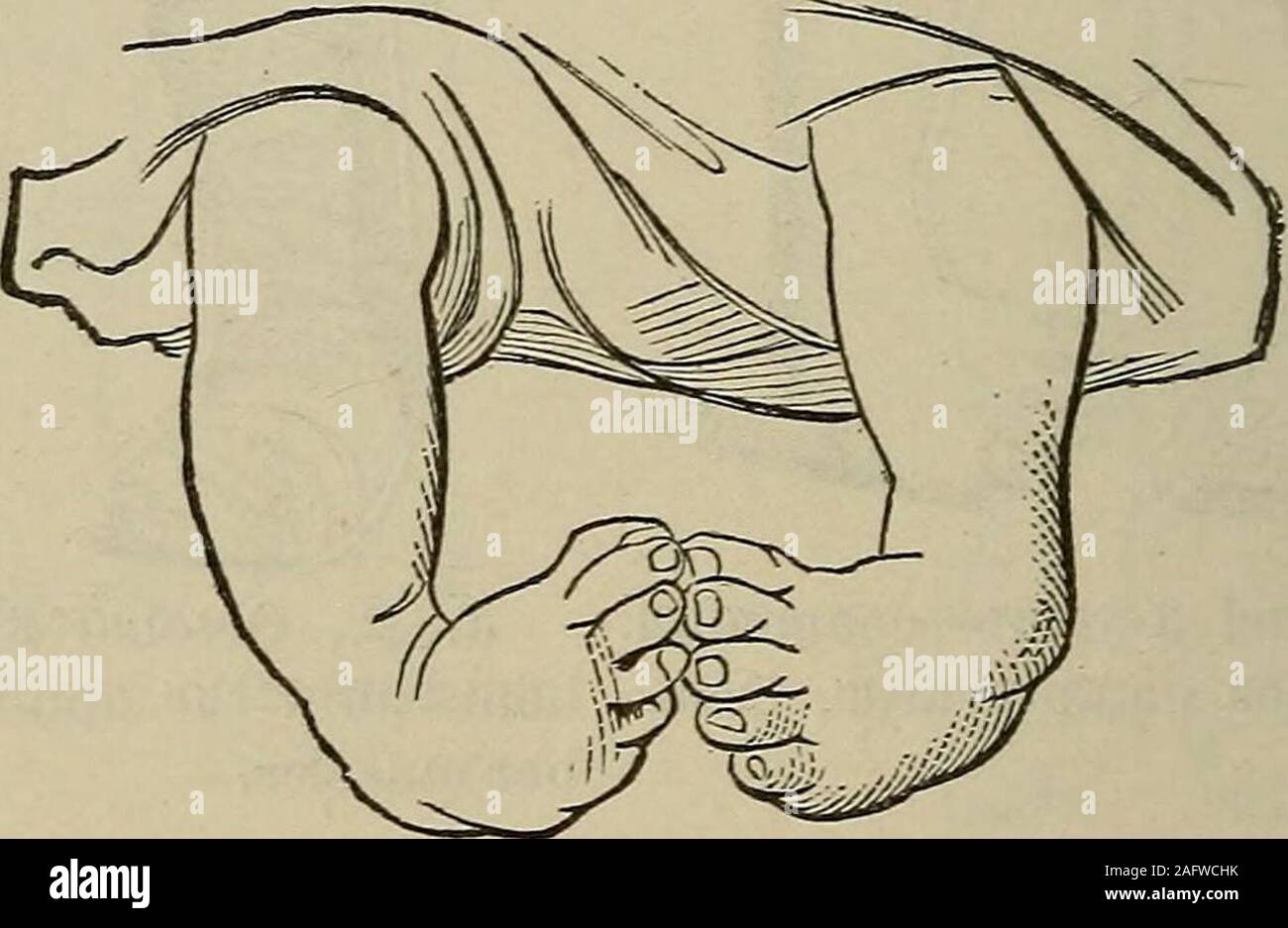 Talipes varus hi-res stock photography and images - Alamy