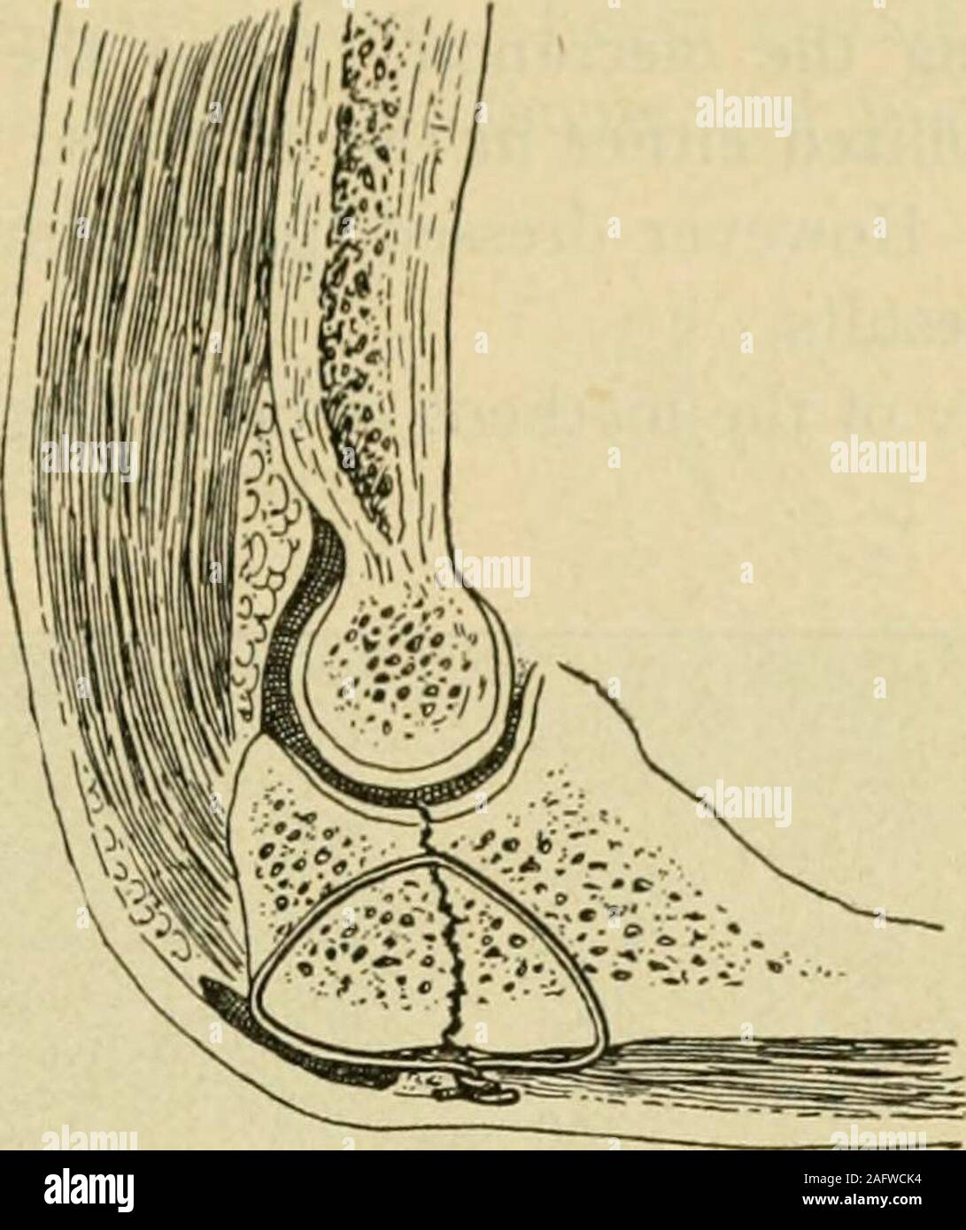 Olecranon Fracture Classification