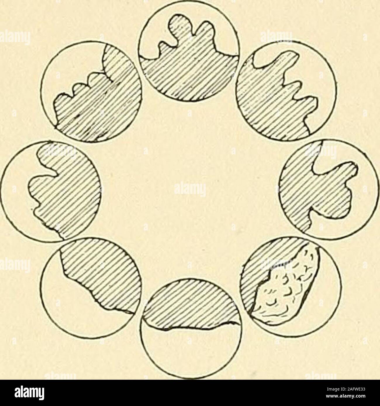 . Studies on hypertrophy and cancer of the prostate. the surface are ...