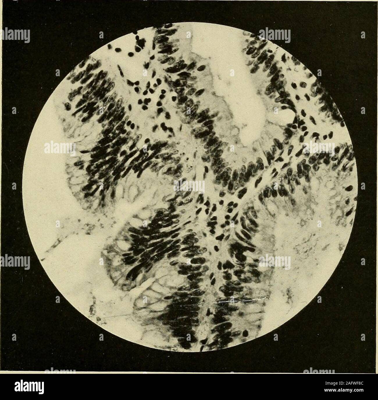 Cancerous transformation hi-res stock photography and images - Alamy