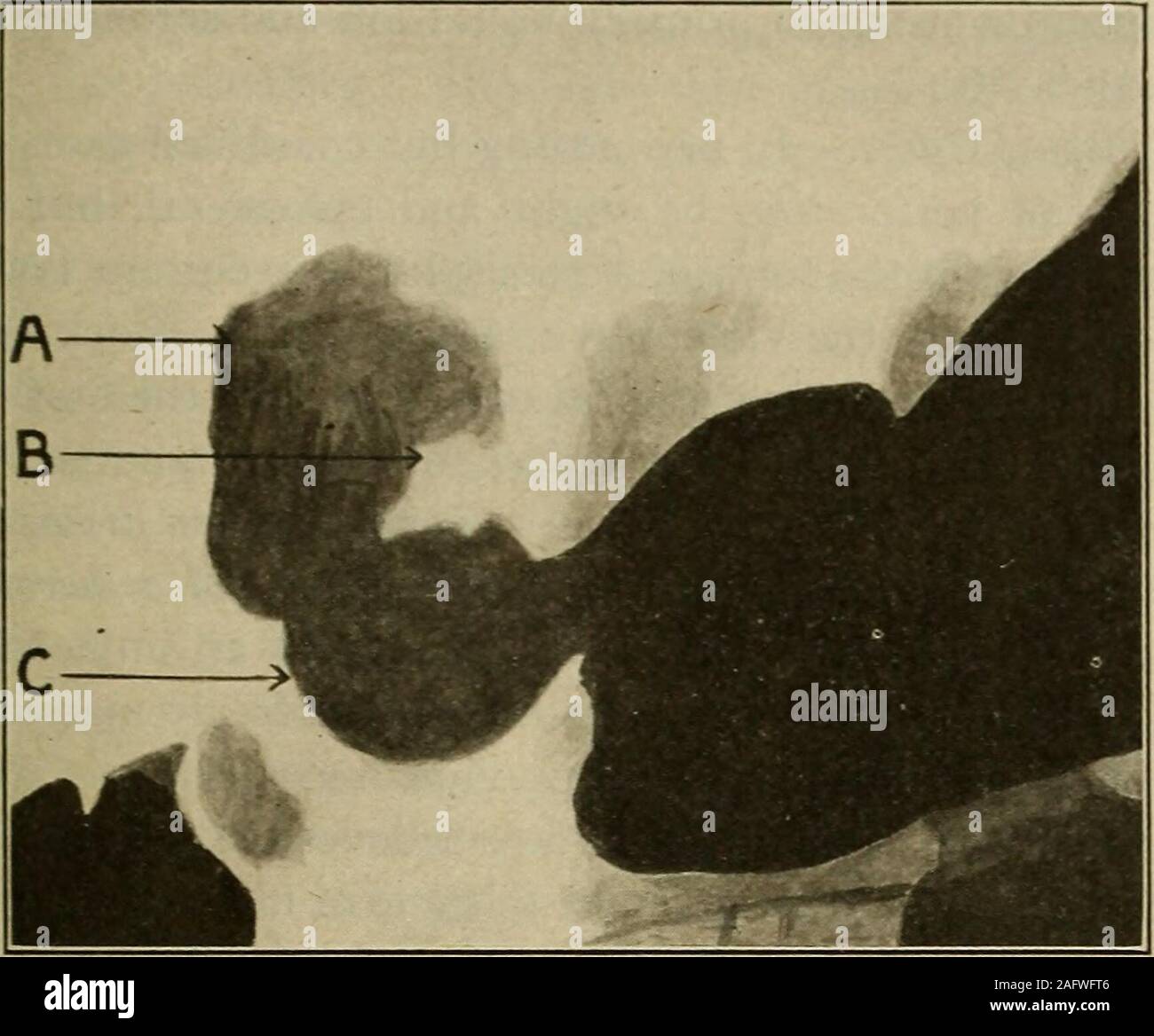 . Medical diagnosis for the student and practitioner. Fig. 470.—Ulcer ...