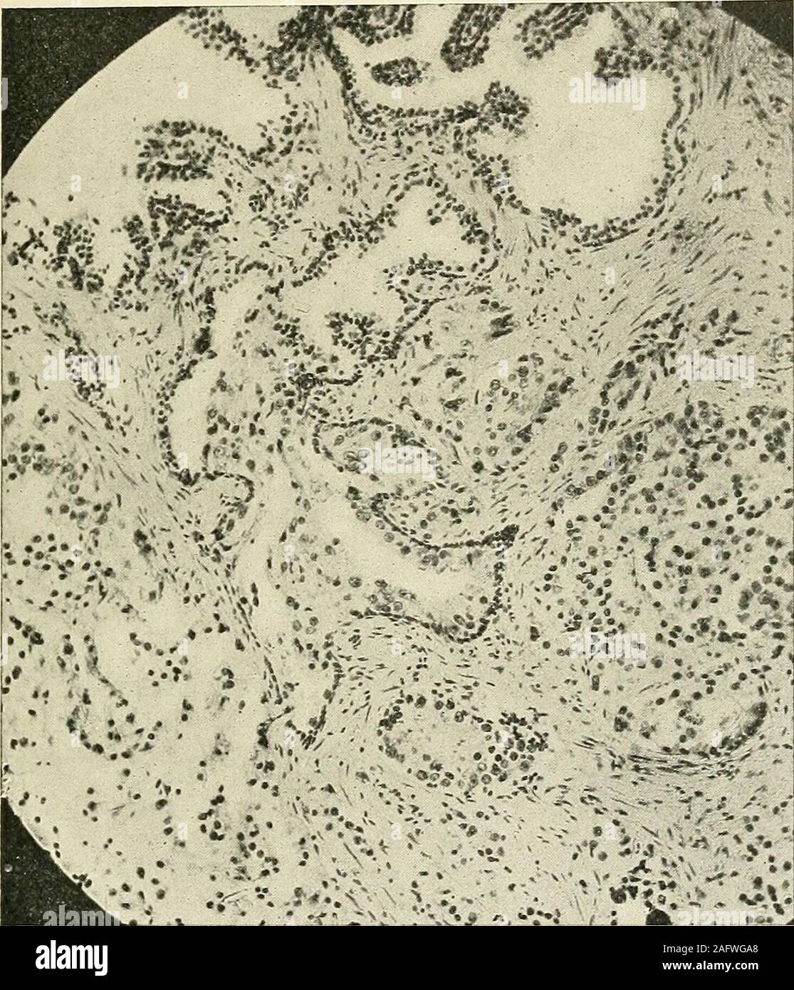 Prostate cancer adenocarcinoma hi-res stock photography and images - Alamy