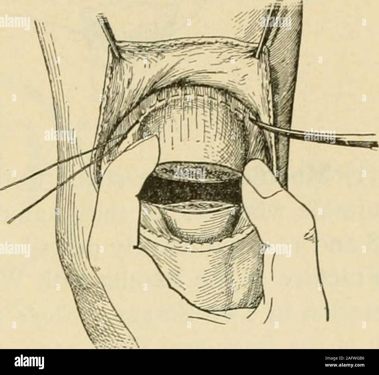 . Manual of operative surgery. Fig. 1113.—Suture of capsular ligament ...