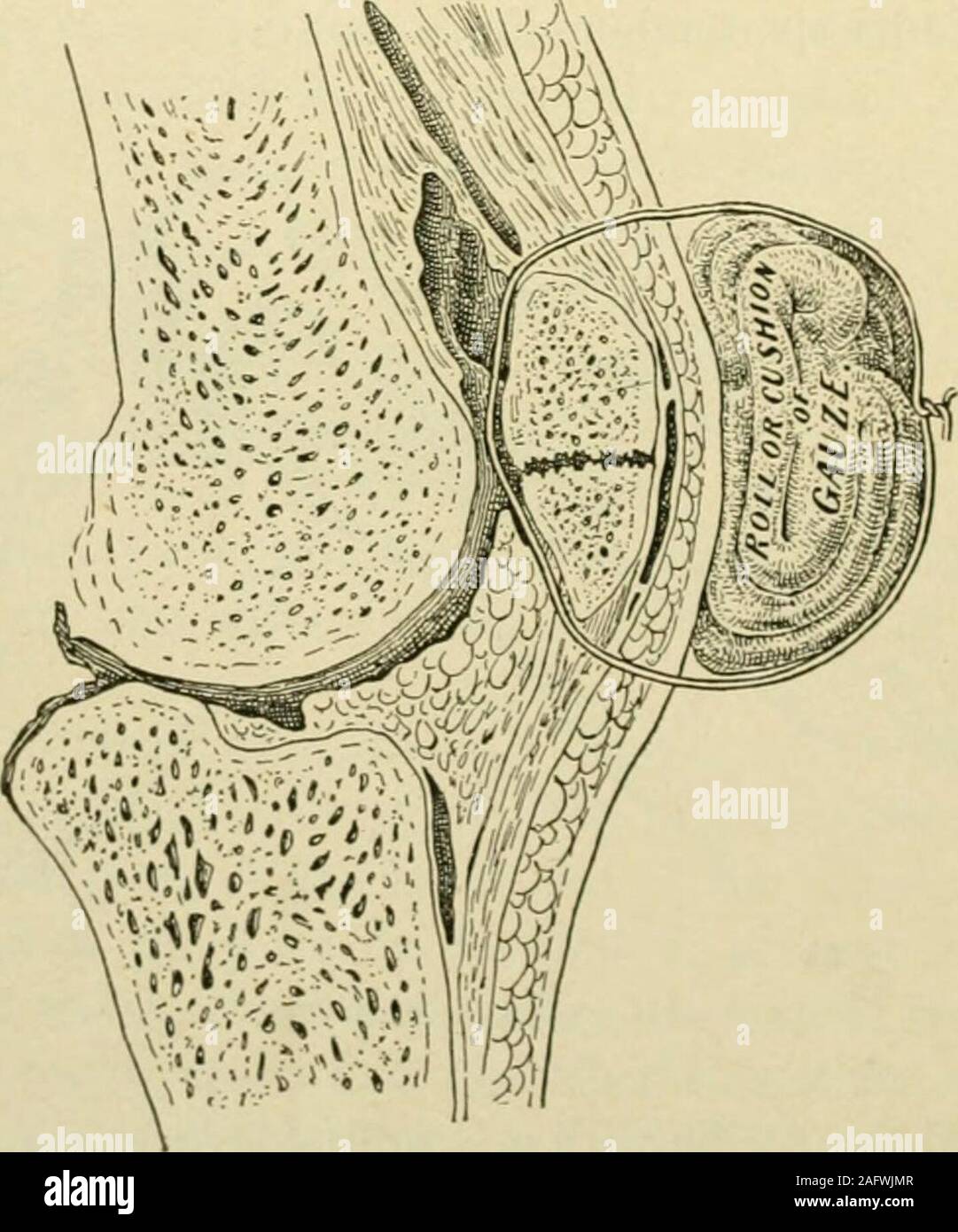 Twisted Suture High Resolution Stock Photography and Images - Alamy