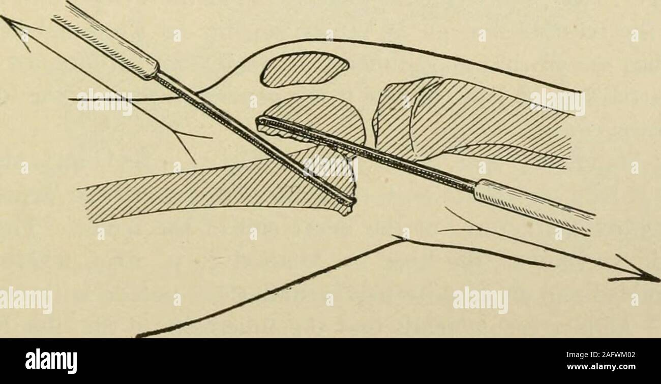Quadriceps tendon surgery hi-res stock photography and images - Alamy