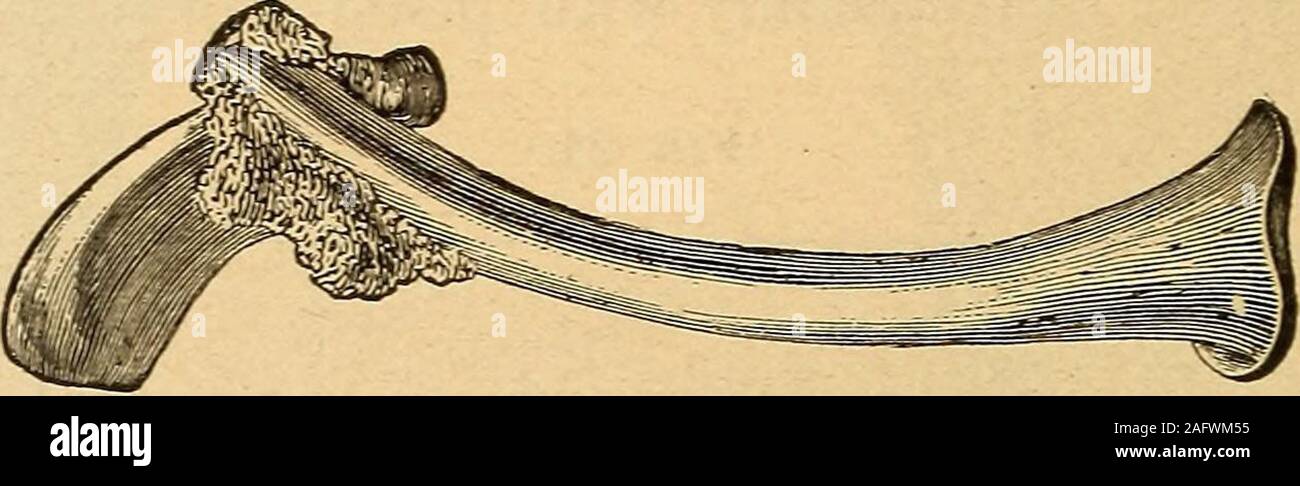Transverse bone fracture hi-res stock photography and images - Alamy