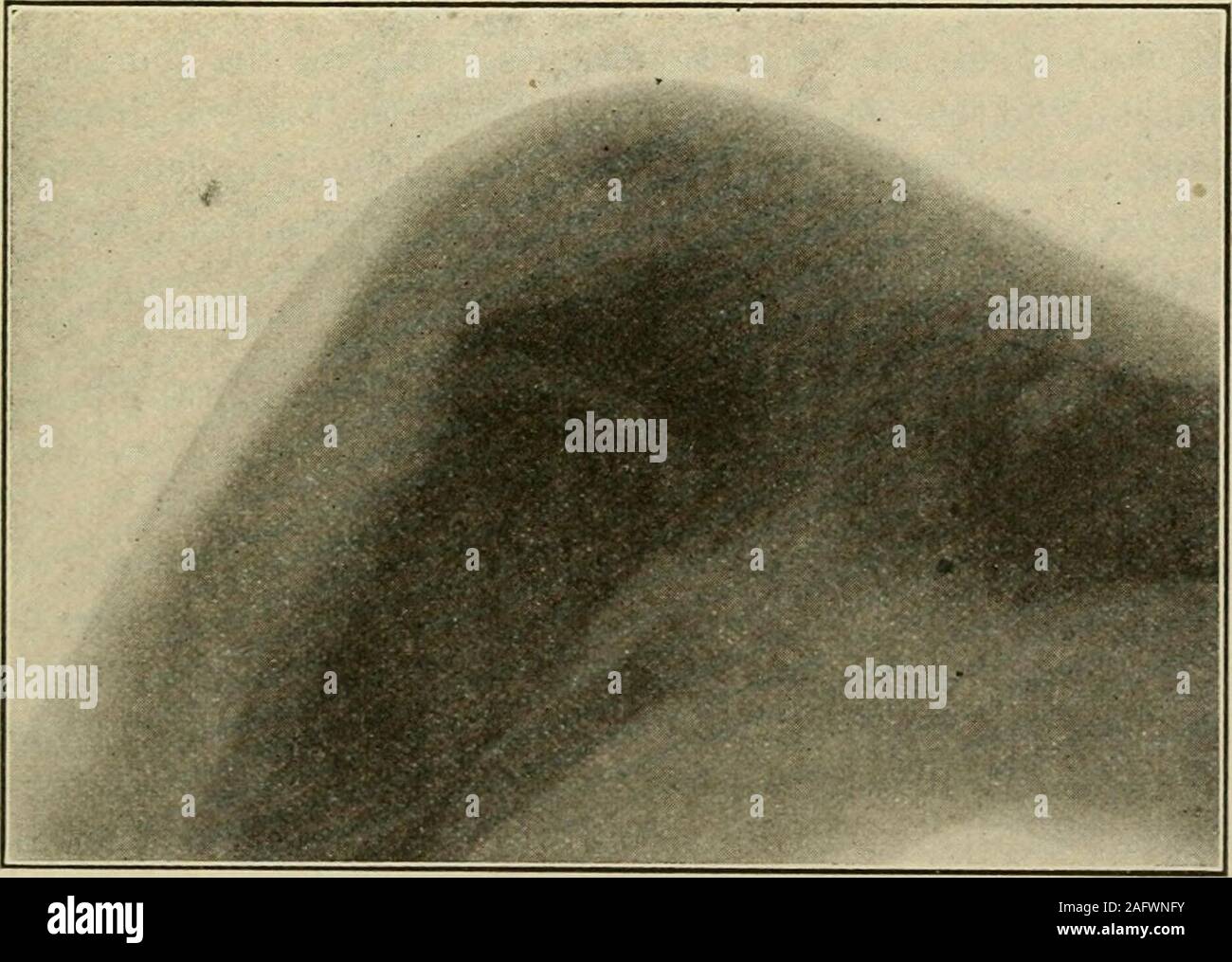 . Manual of operative surgery. Fig. 1094.—Separation of lower femoral ...