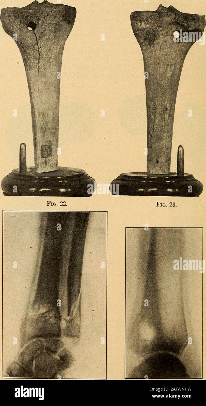 . A practical treatise on fractures and dislocations. Figs. 18 and 19 ...