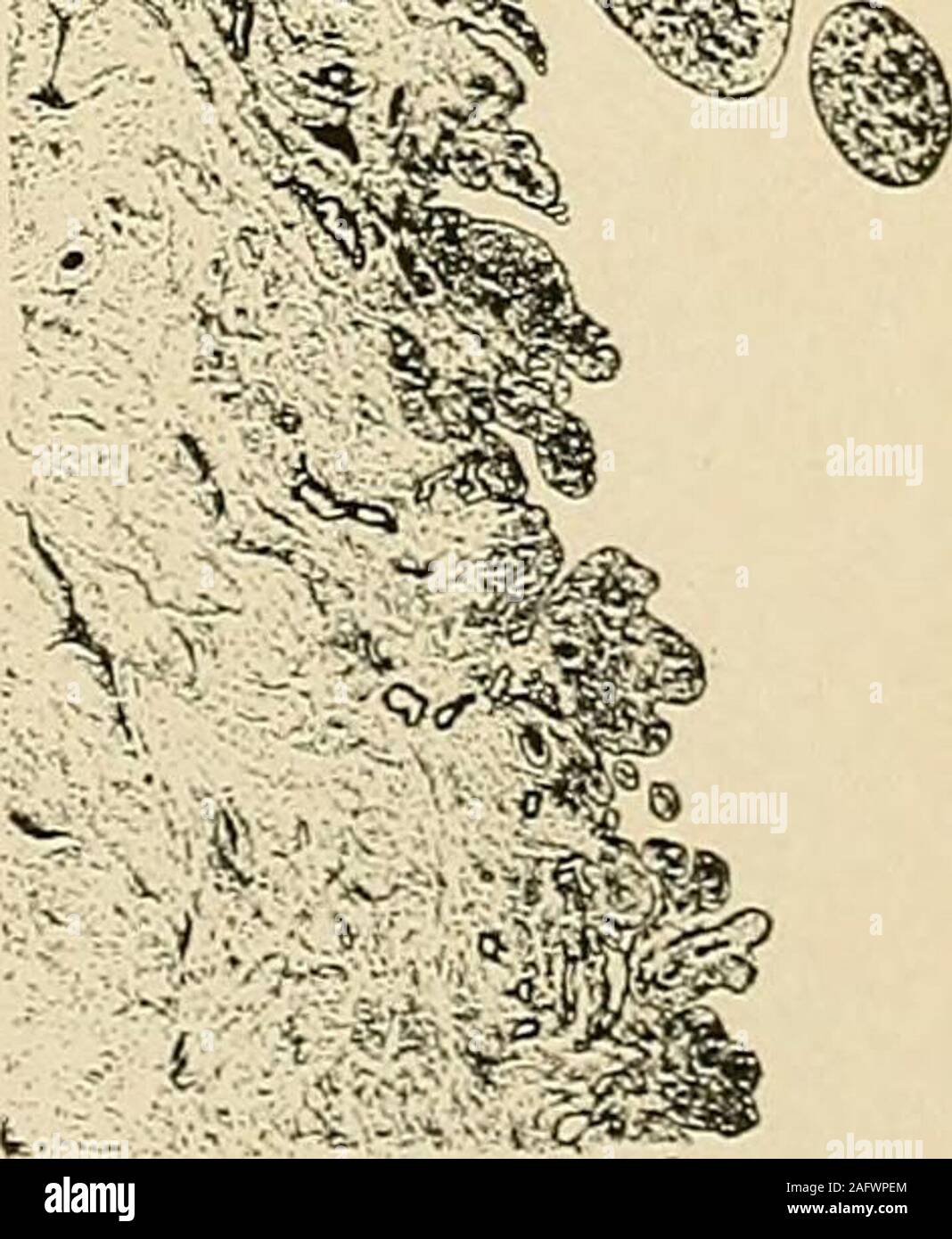 Acute salpingitis hi-res stock photography and images - Alamy
