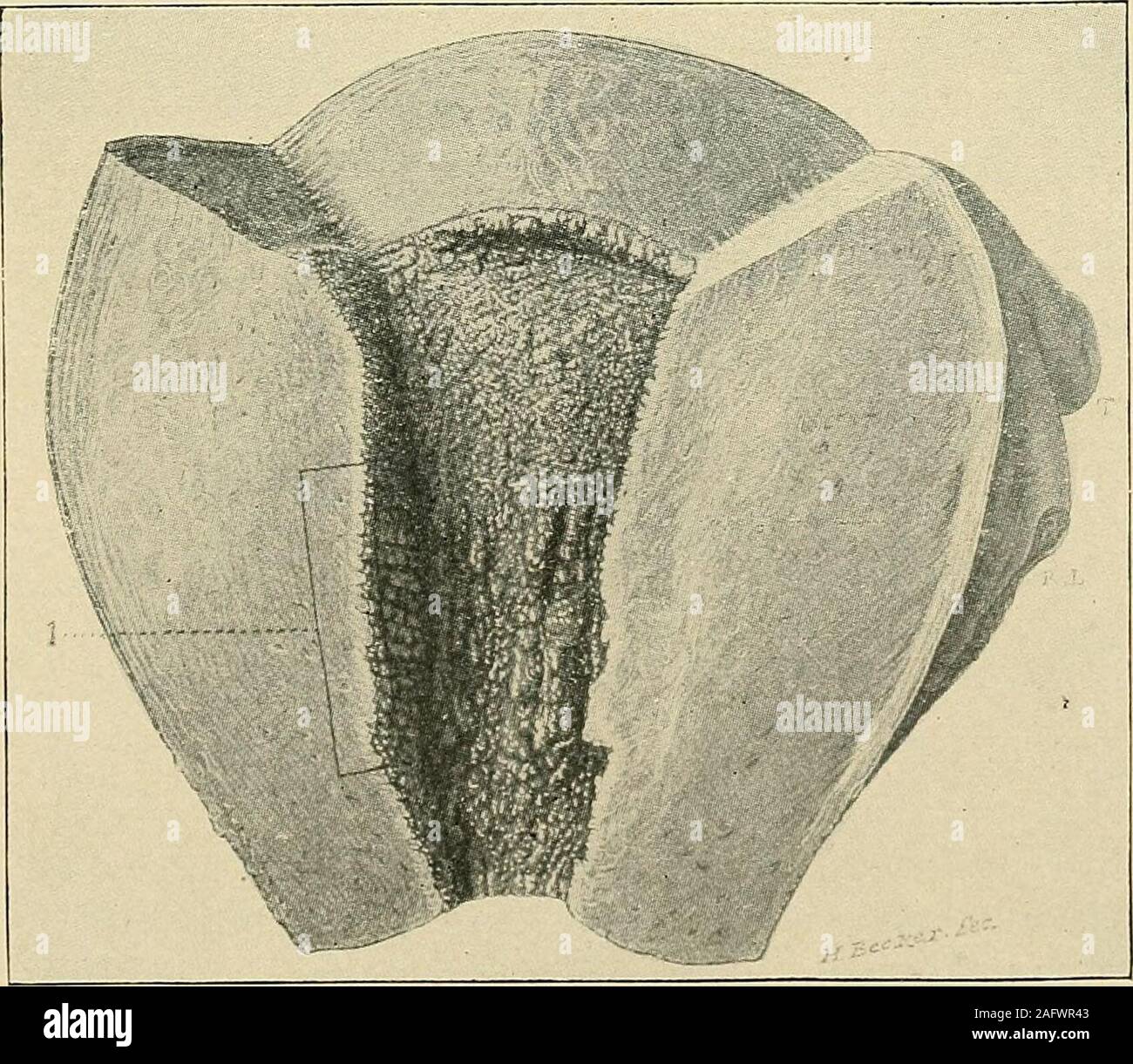 Uterine hypertrophy hi-res stock photography and images - Alamy