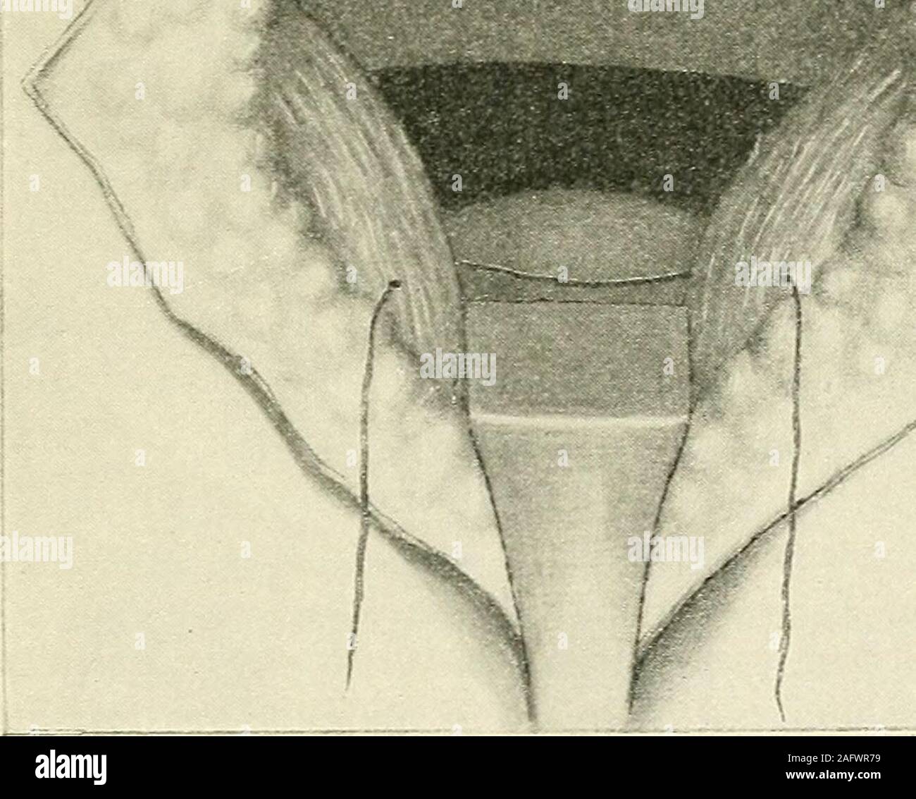 . Studies on hypertrophy and cancer of the prostate. capsule. A re ...