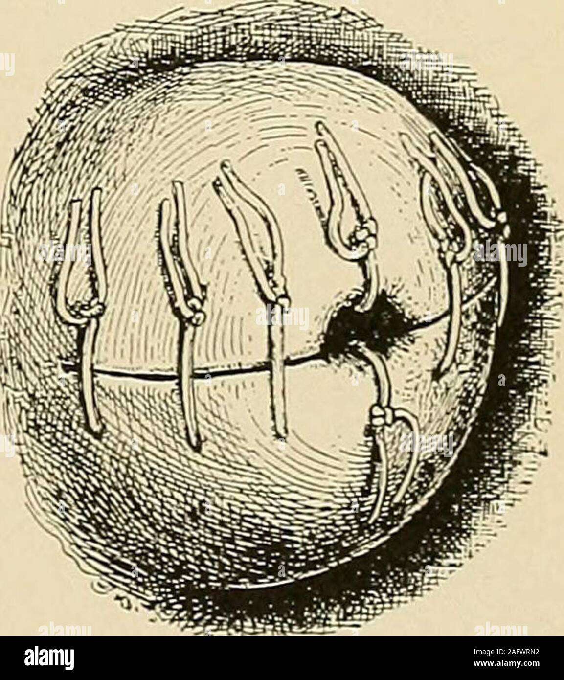 Cervix excision hi-res stock photography and images - Alamy