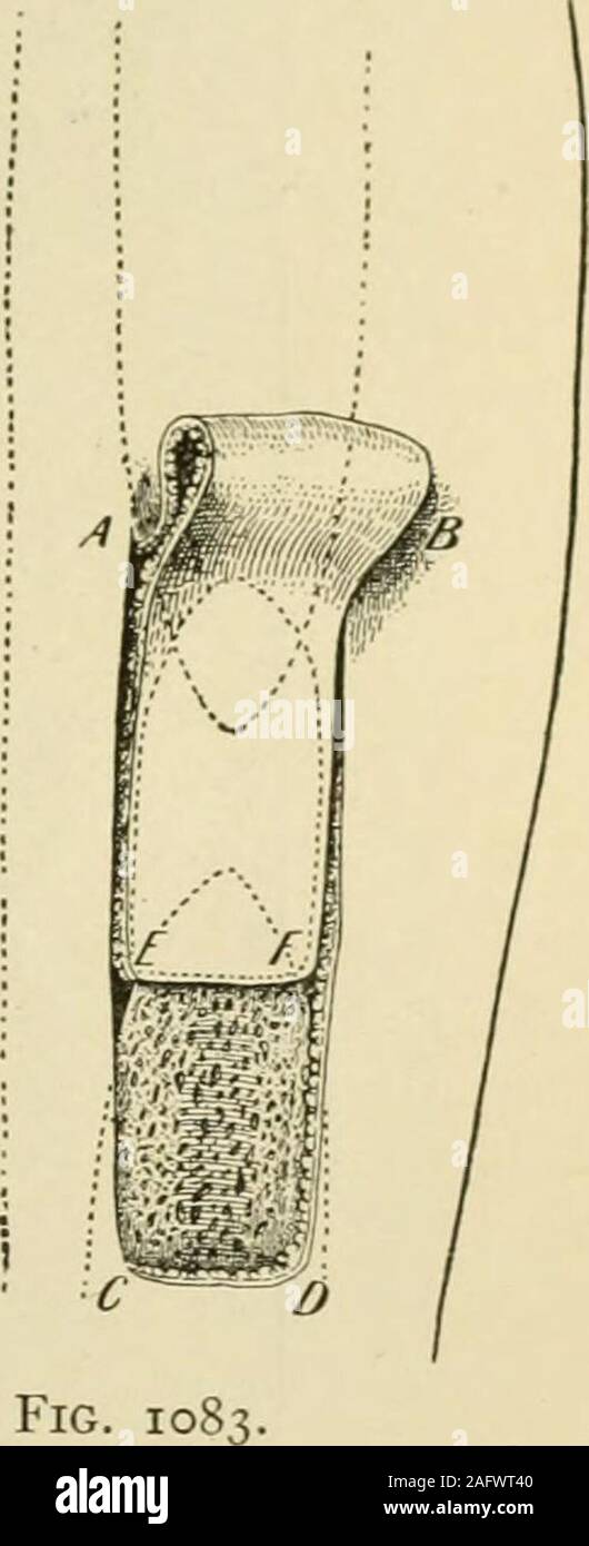 . Manual of operative surgery. I ) Fig. 1082.. Figs. 1082 and 1083 ...
