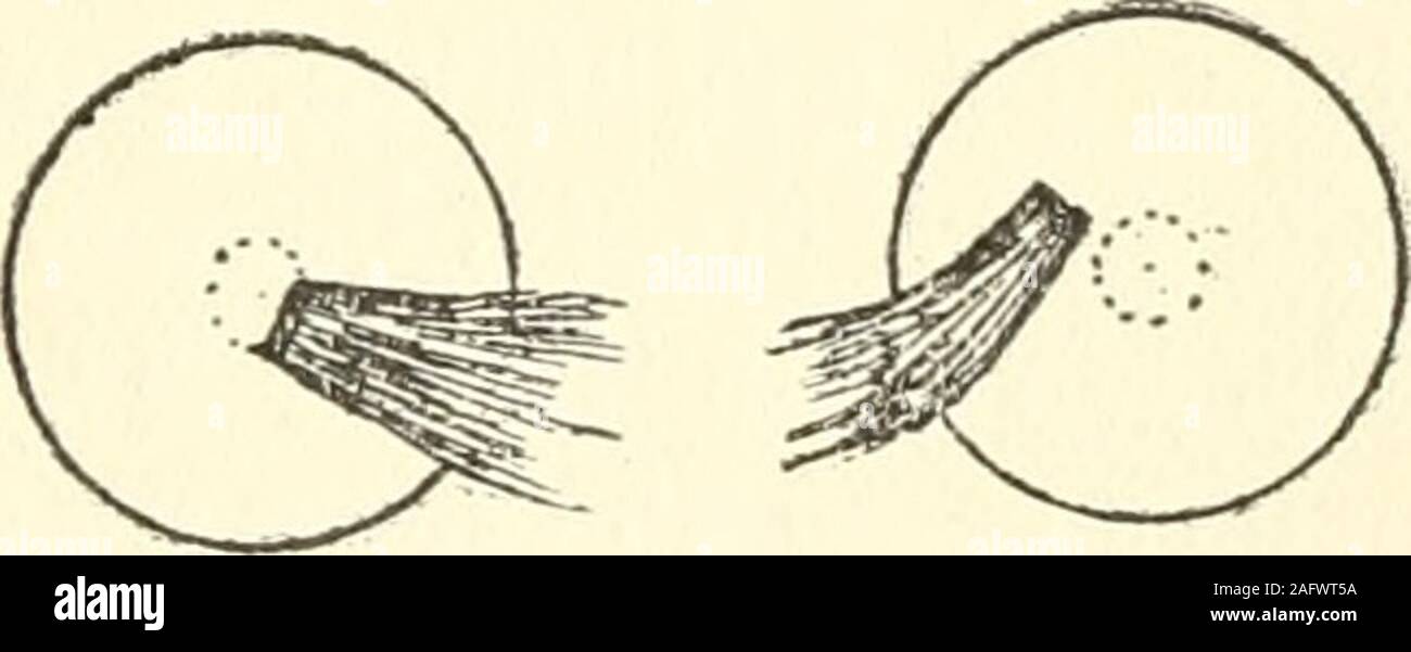 . Oftalmología; estadística [1.]-3. ser. Fig. 35.—Pterygion interno en ...