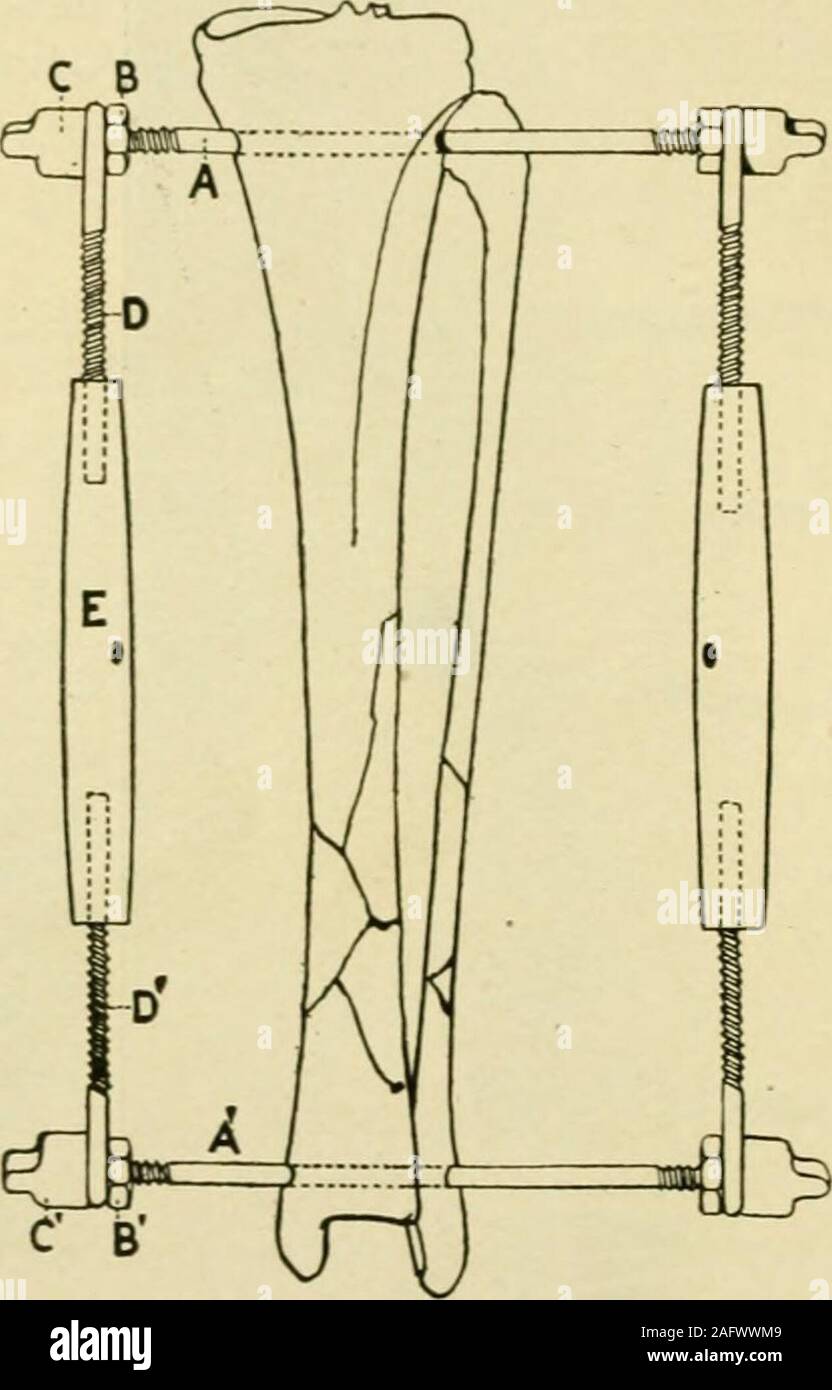 Protruding Bones High Resolution Stock Photography and Images - Alamy