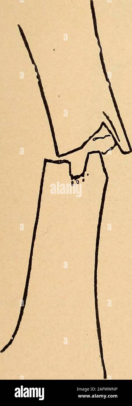 . A practical treatise on fractures and dislocations. separation of a ...