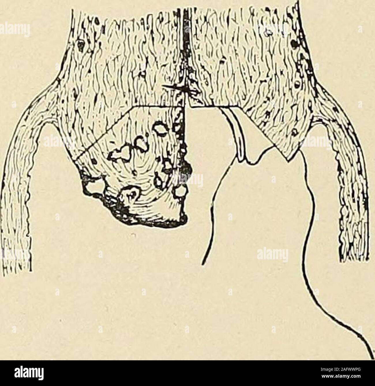 Cervix excision hi-res stock photography and images - Alamy