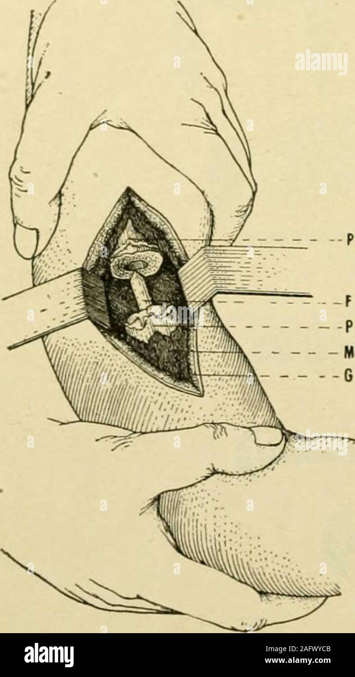 . Manual of operative surgery. rphy uses a transplant from the same pa ...