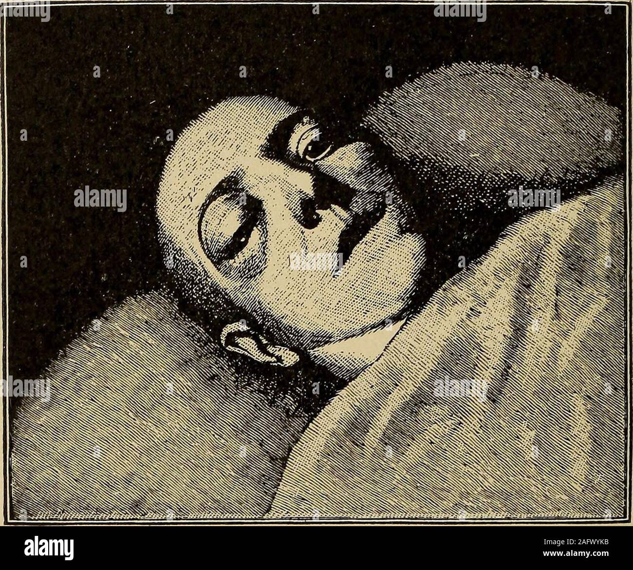 Aural abscess hi-res stock photography and images - Alamy