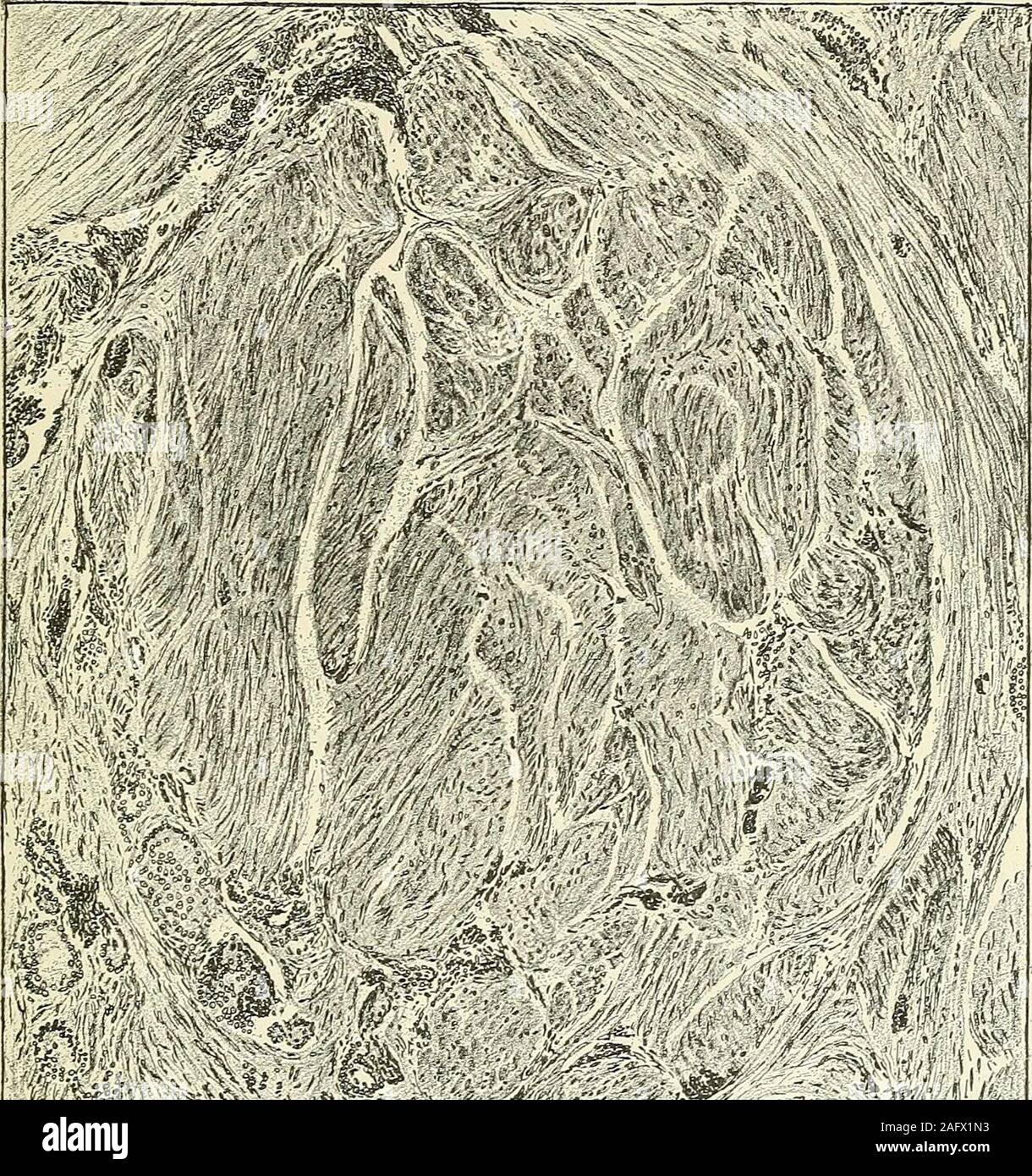 Hyperplasia hypertrophy hi-res stock photography and images - Alamy