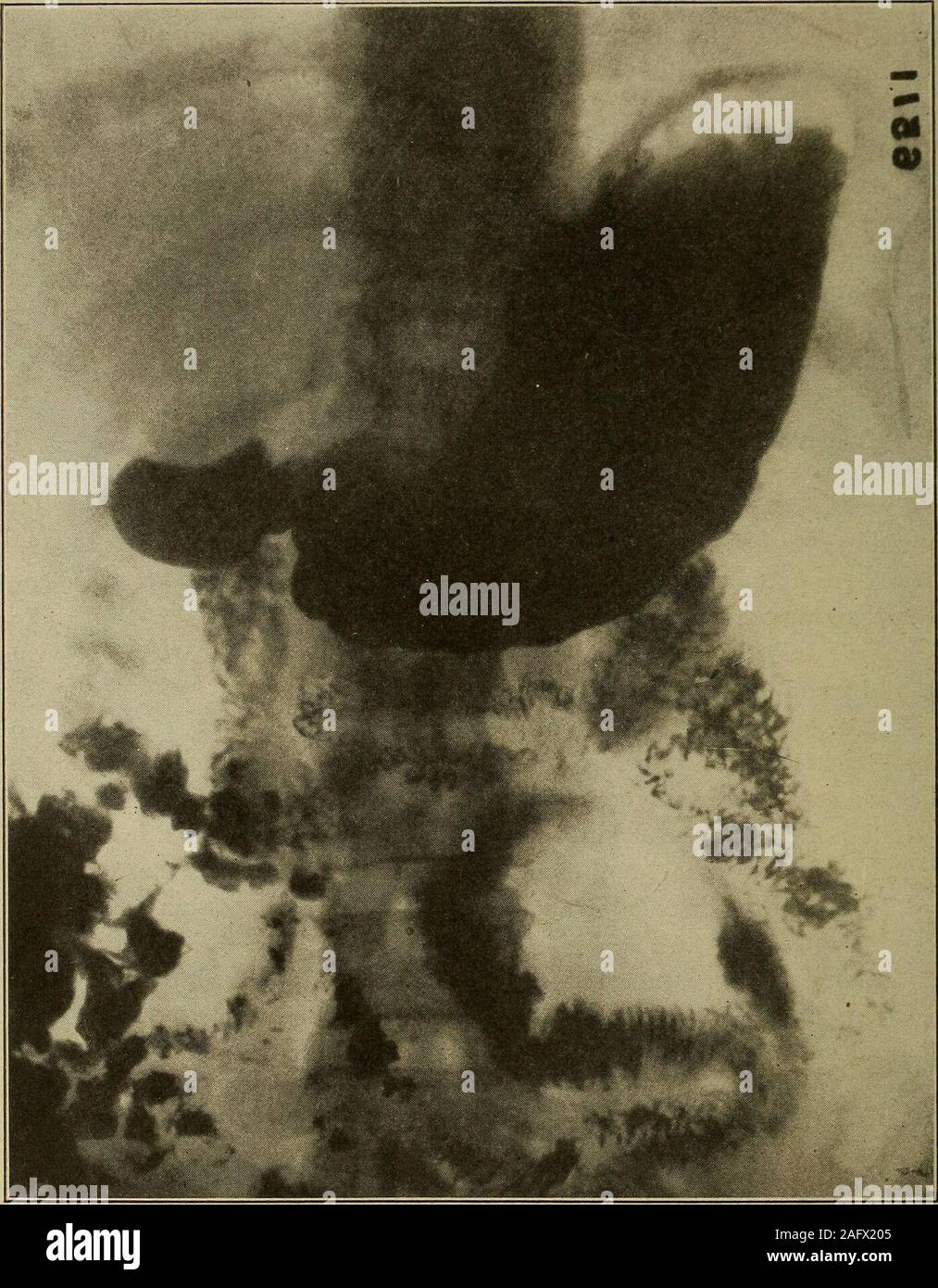 Retrocecal appendicitis hi-res stock photography and images - Alamy