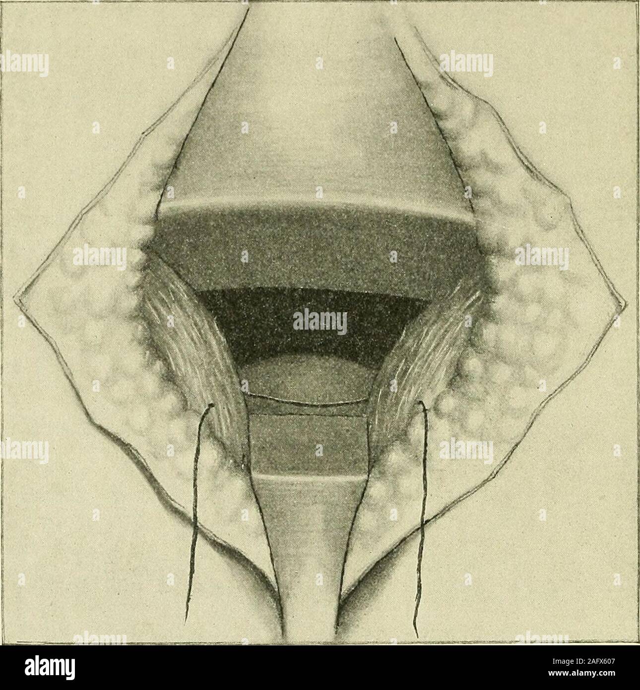 Bladder drainage hi-res stock photography and images - Alamy