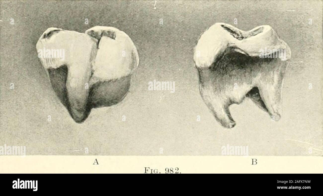Supernumerary teeth hi-res stock photography and images - Alamy