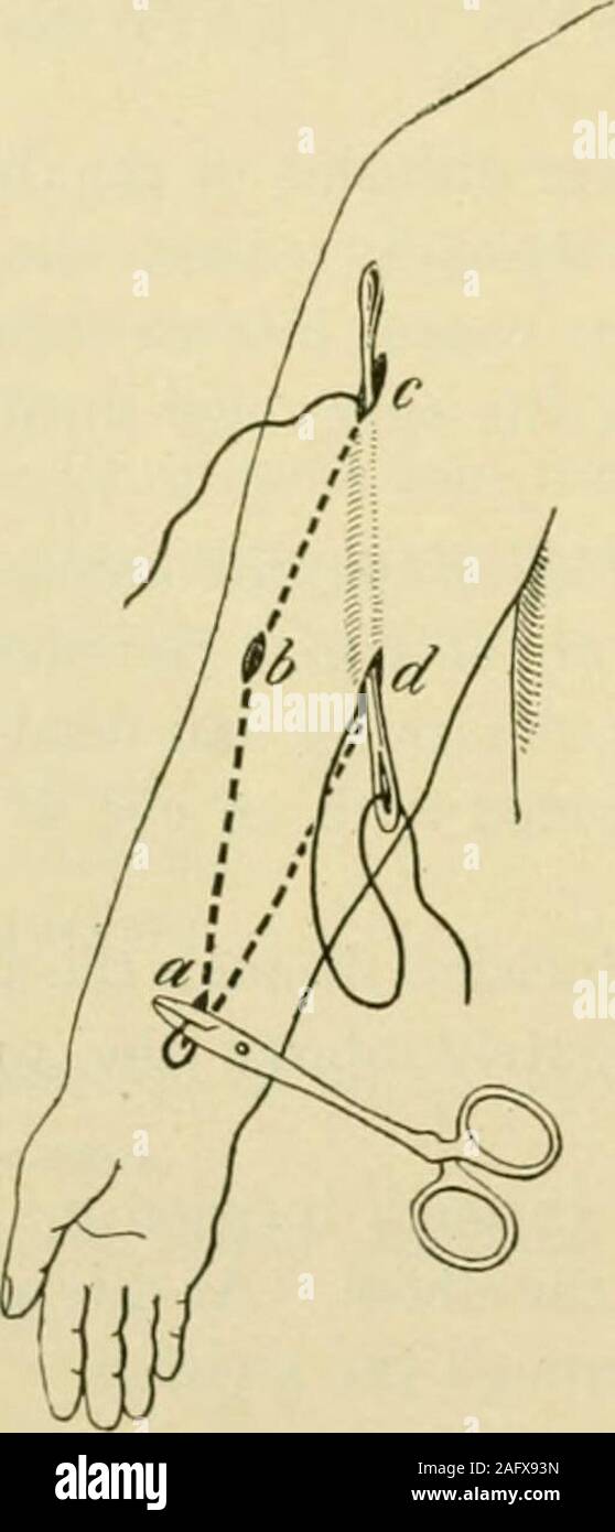 Surgery Shoulder Incision High Resolution Stock Photography and Images ...