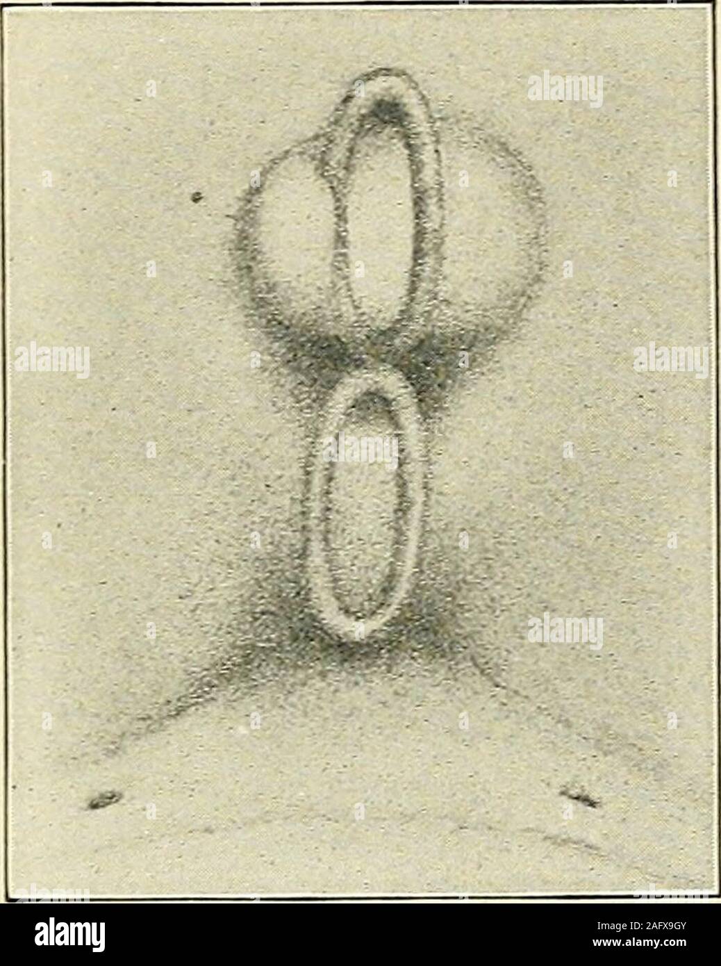 . Studies on hypertrophy and cancer of the prostate. median lobe ...
