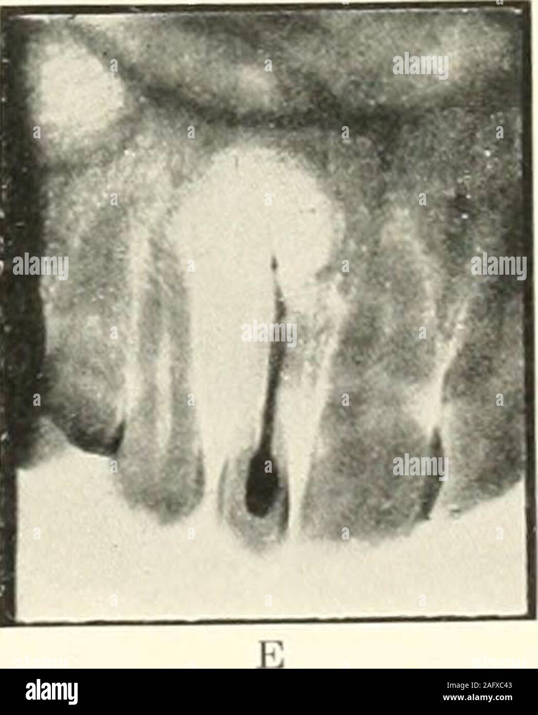 Abscessed hi-res stock photography and images - Alamy