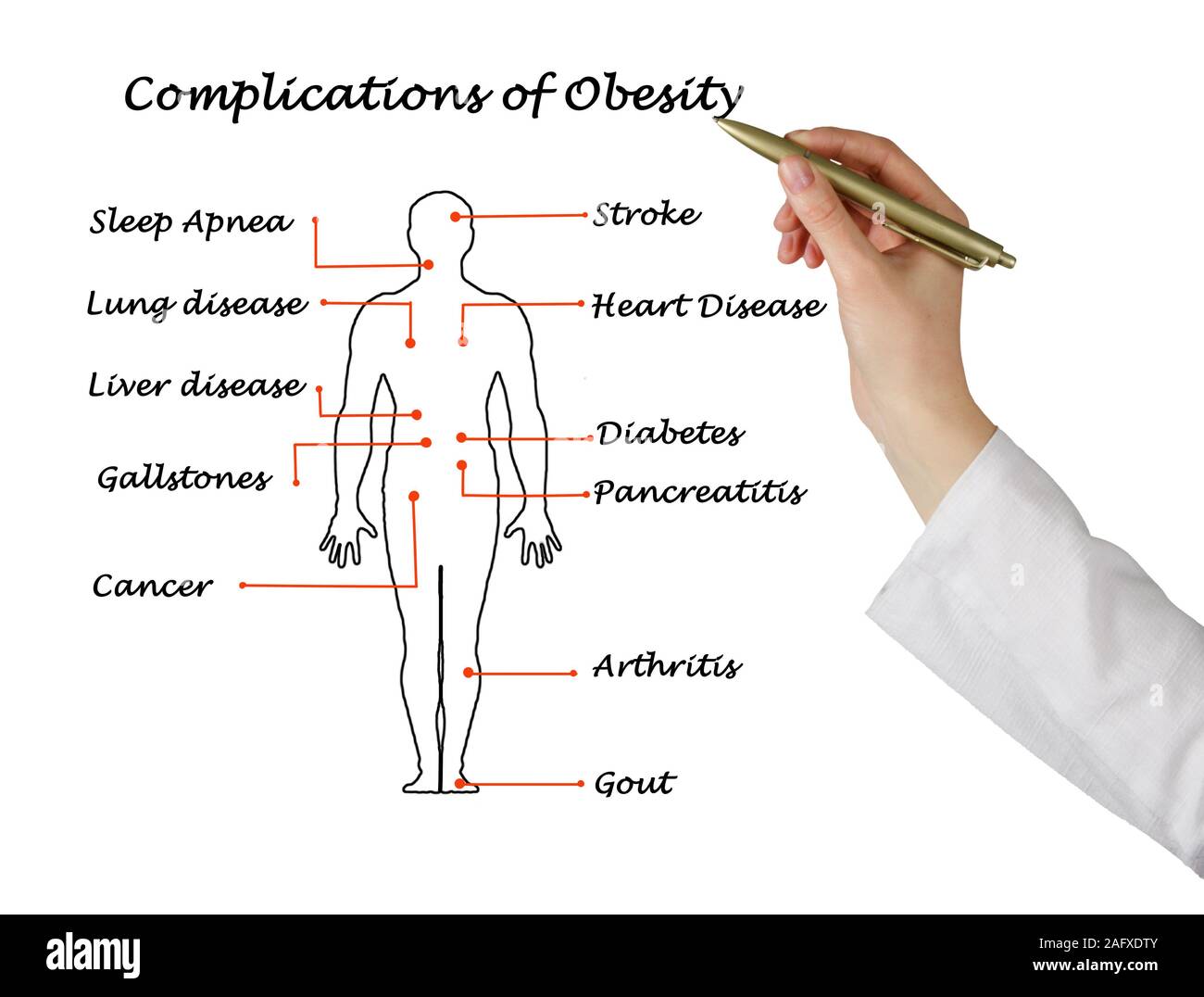 Obesity complications hi-res stock photography and images - Alamy