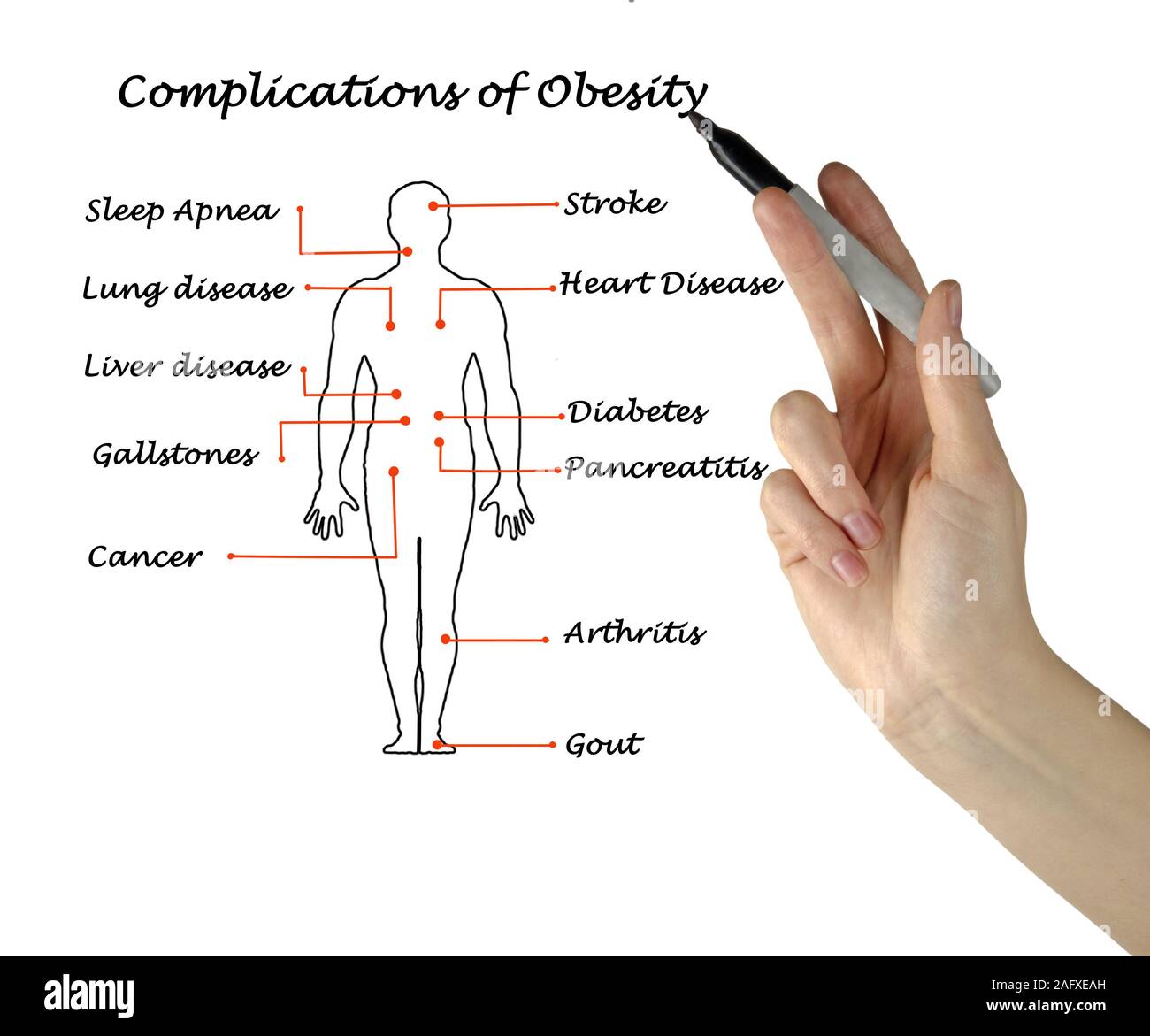 Obesity complications hi-res stock photography and images - Alamy