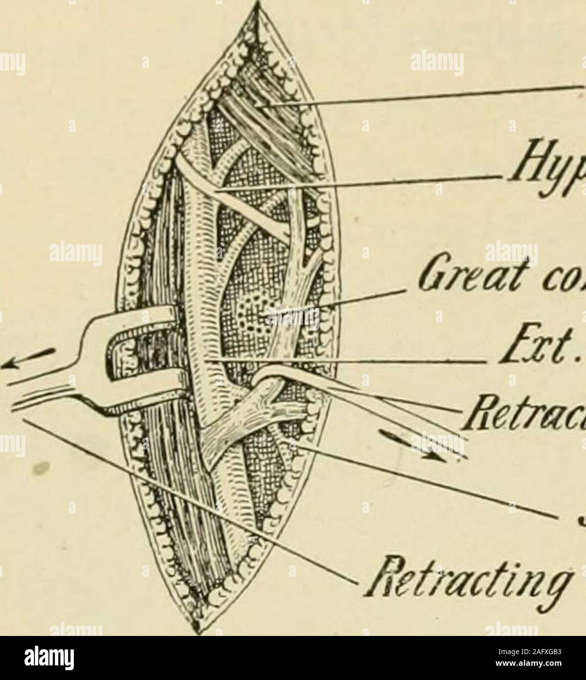 . Manual of operative surgery. Sterno-thyroid Fig. iooo.—(Esinarch ...