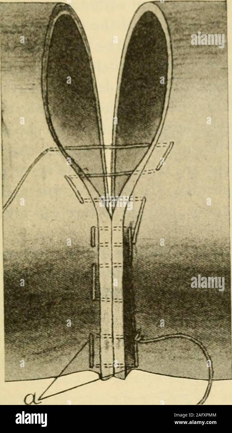 . Manual of operative surgery. Fig. 971.—Payrs magnesium. Fig. 972. Fig ...