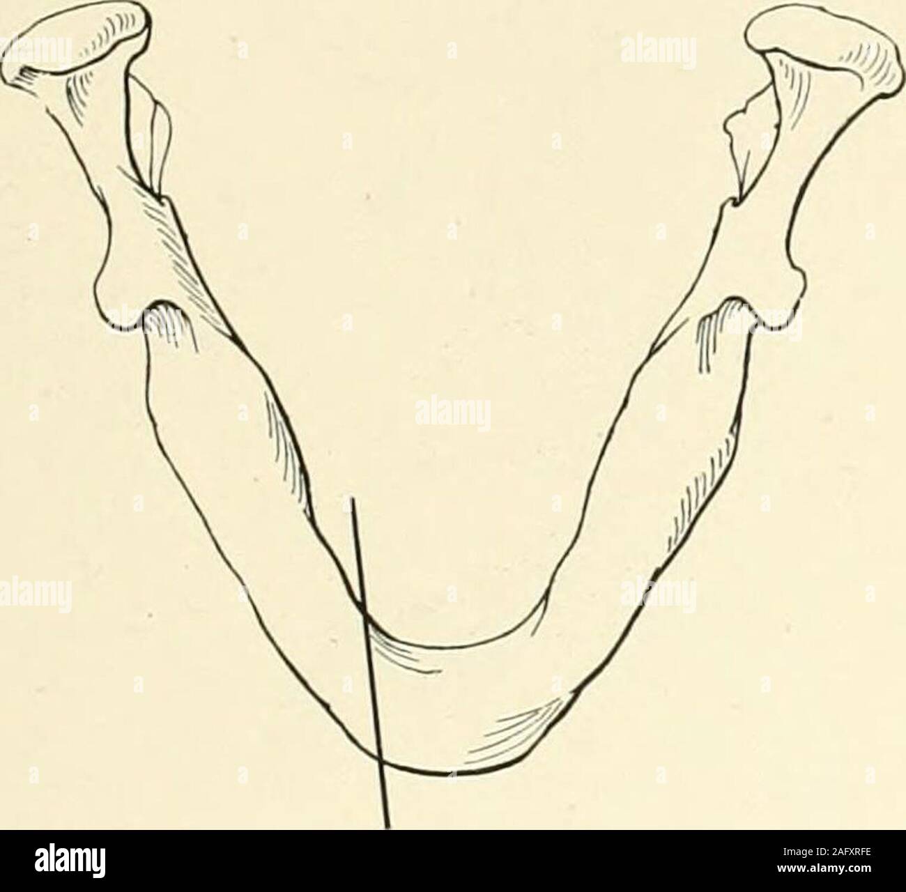 Double fracture hi-res stock photography and images - Alamy