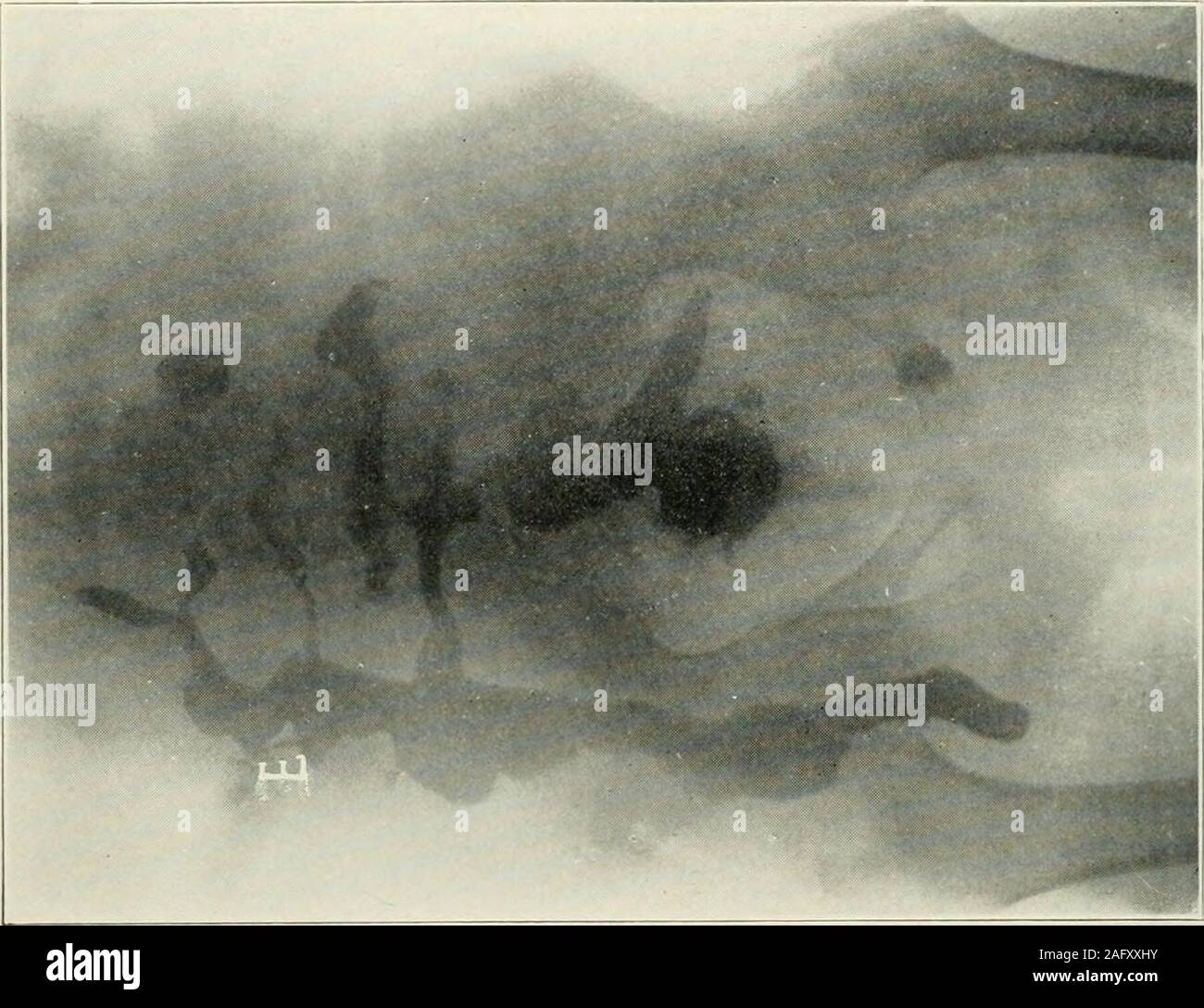 Formation of an abscess hi-res stock photography and images - Alamy